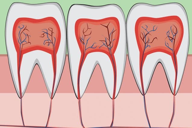 What is a Root Canal Treatment? - Dentist North York